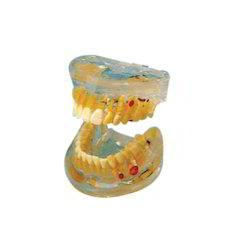 Dental Study Model Adult Pathological